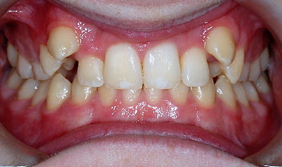 Before and After Orthodontic Treatment Results